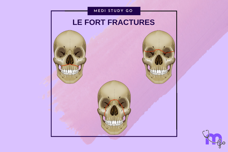 Le Fort Fractures: Classification, Clinical Features, and Management ...