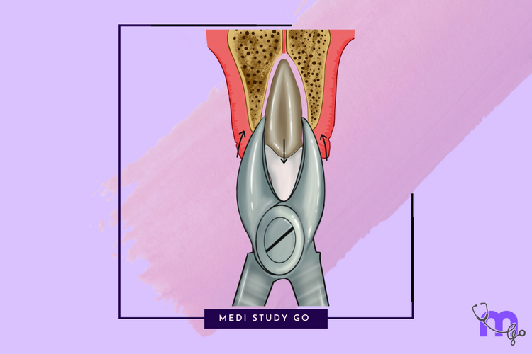 Surgical Extraction Procedures: A Comprehensive Guide – Medi Study Go